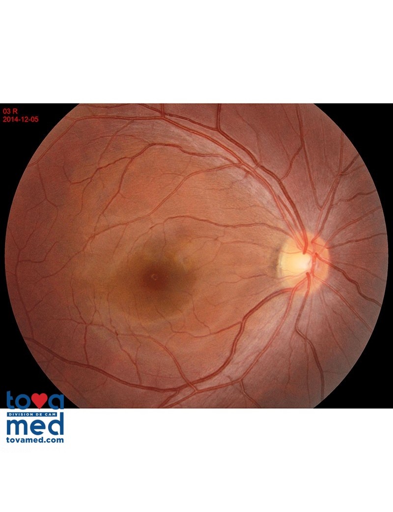 FUNDUS CAMERA AUTO FOCUS